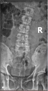 Low Back Pain & Spinal Misalignment: Causes & Chiropractic Care ...